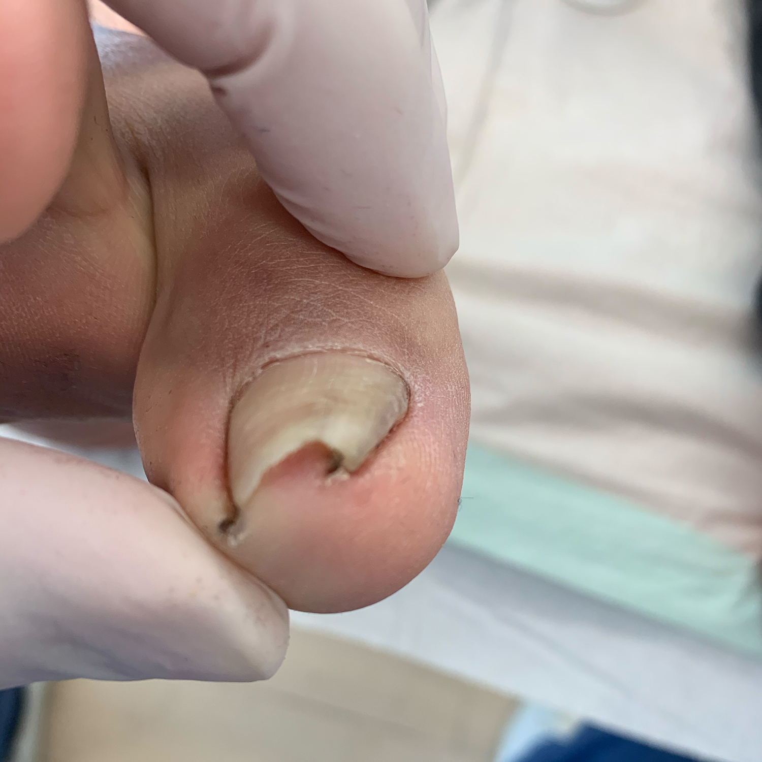 Eingewachsener Nagel – Unguis incarnatus – eingewachsener Zehennagel ...