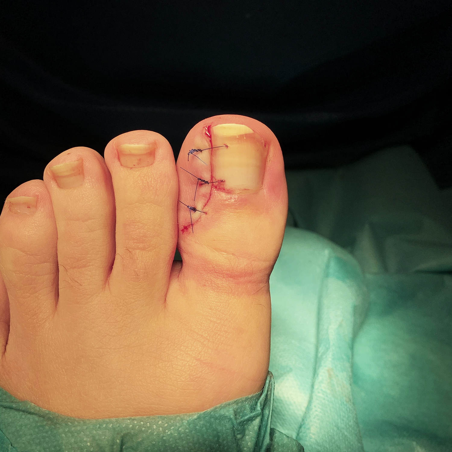 Eingewachsener Nagel – Unguis incarnatus – eingewachsener Zehennagel ...