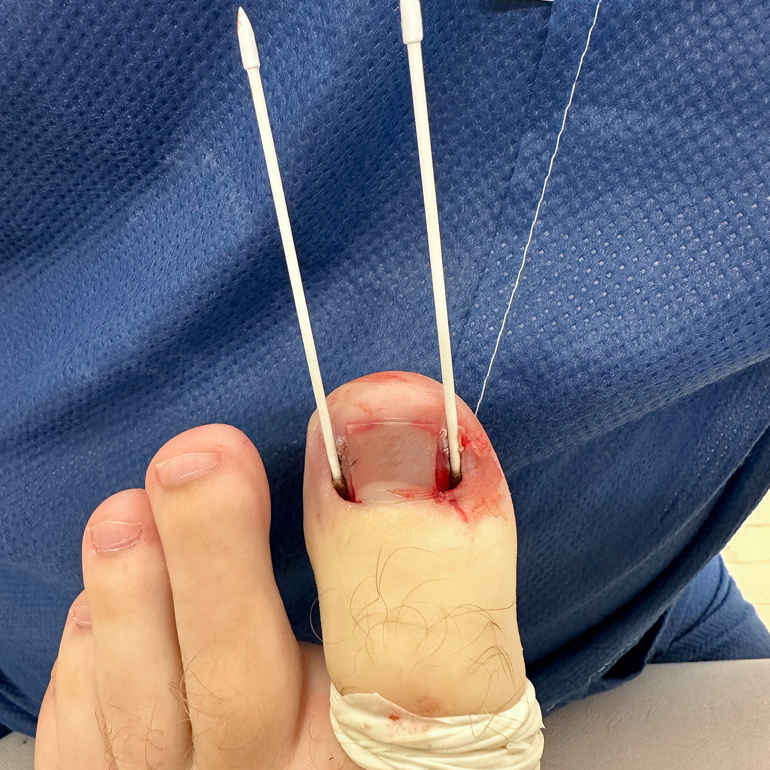 Eingewachsener Nagel – Unguis incarnatus – eingewachsener Zehennagel ...