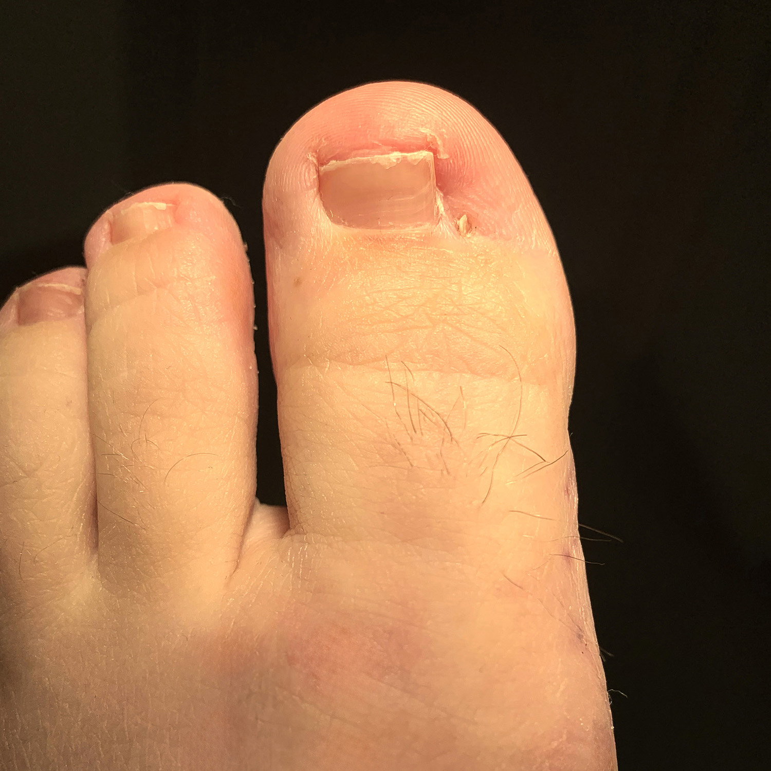 Eingewachsener Nagel – Unguis incarnatus – eingewachsener Zehennagel ...