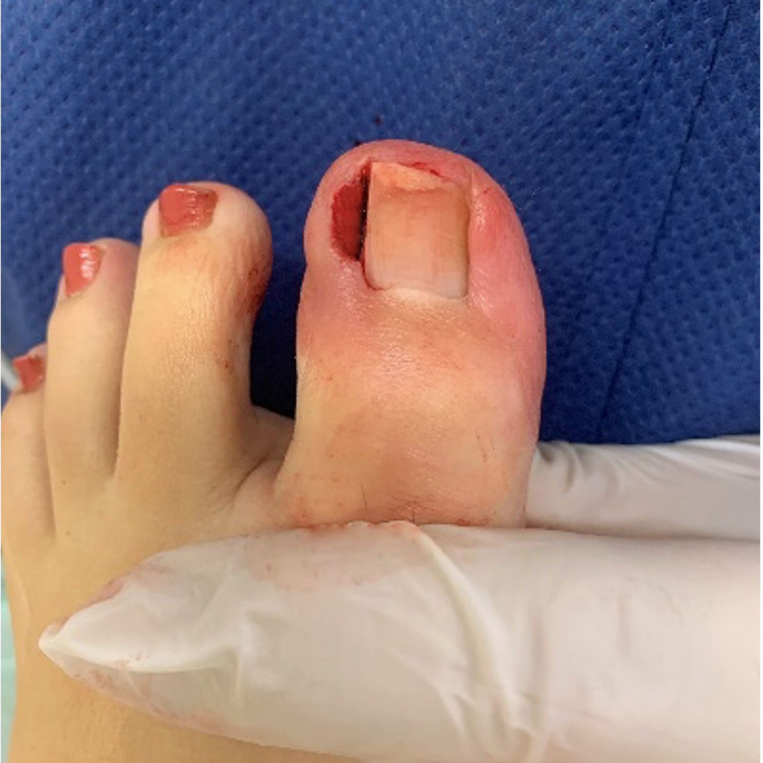 Eingewachsener Nagel – Unguis incarnatus – eingewachsener Zehennagel ...