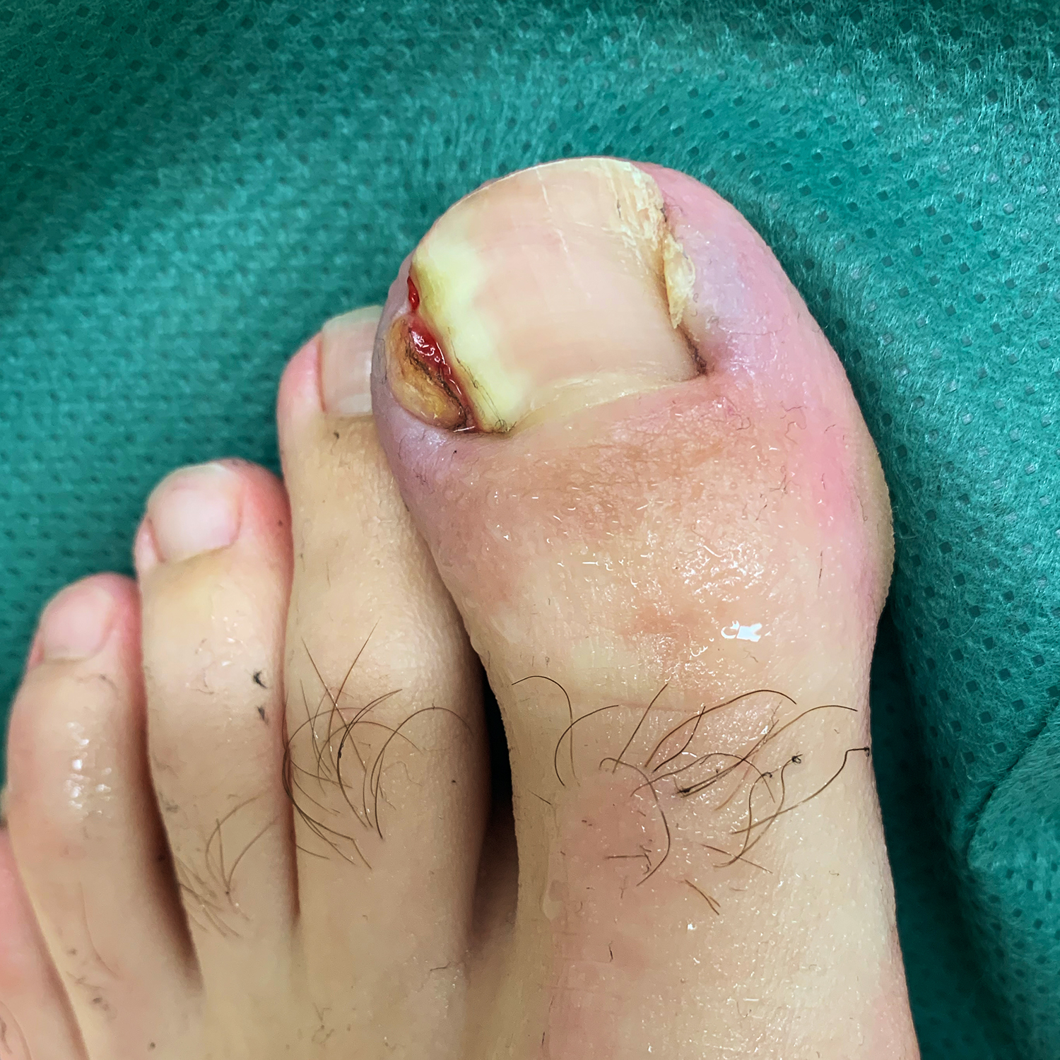 Eingewachsener Nagel – Unguis incarnatus – eingewachsener Zehennagel ...